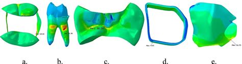 Stress Distribution Of An Endodontically Treated Tooth Ccide