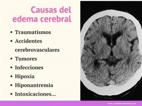 Edema Cerebral Causas Síntomas y Tratamiento