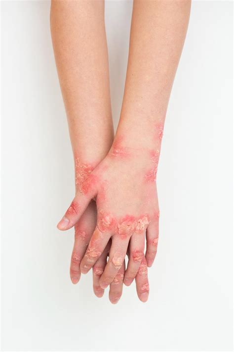 Best Skincare Routine For Psoriasis Swaarnim Ayurveda