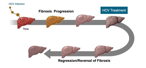 Core Concepts Treatment Of Hcv In Persons With Cirrhosis Treatment