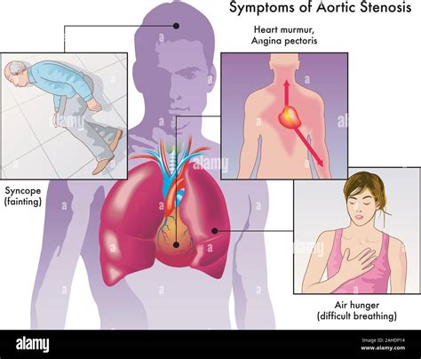Medical Illustration Of The Symptoms Of Aortic Stenosis Stock Vector Image And Art Alamy