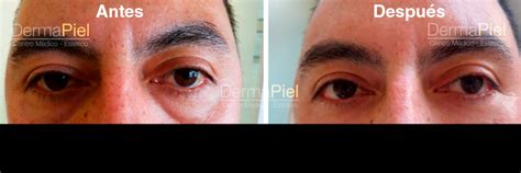 Relleno De Ojeras Dermapiel