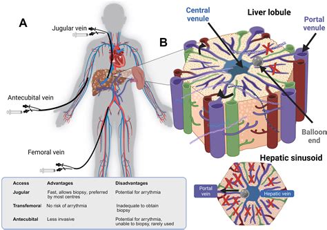 Hepatic Venous Pressure Gradient Clinics In Liver Disease