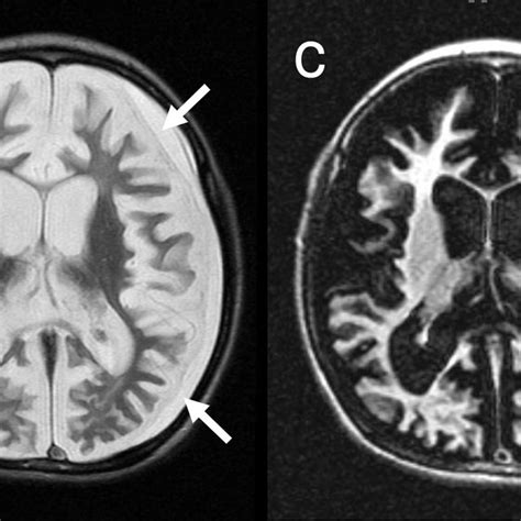 Progression Of Subdural Fluid Collections In Patient Incl 4 The