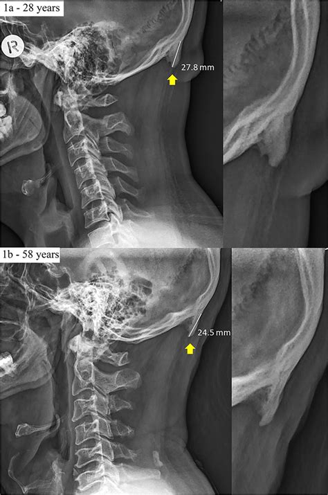 Occipital Protuberance Bump