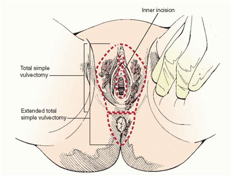 Simple VulvectomyTotal Obgyn Key