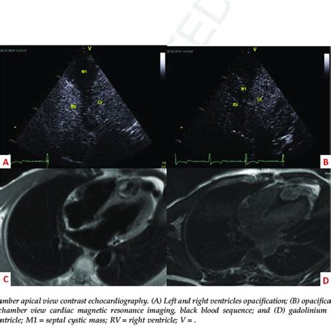 A Electrocardiography ECG Deep Negative T Wave In Leads V3 To V6 Download Scientific