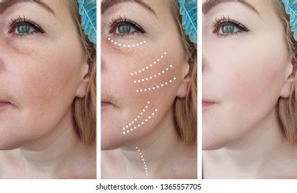 Face Woman Wrinkles Before After Procedures Stock Photo Shutterstock