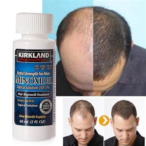 KIRKLAND Signature Minoxidil 5% Topical Solution Extra Strength Hair ...
