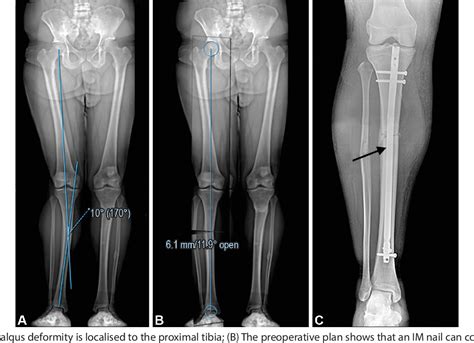 Figure 2 From Blocking Screw Assisted Intramedullary Nailing Using The