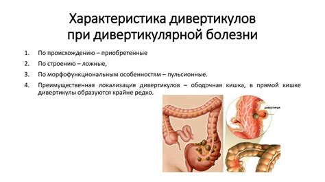 Дивертикулярная болезнь Определение презентация онлайн