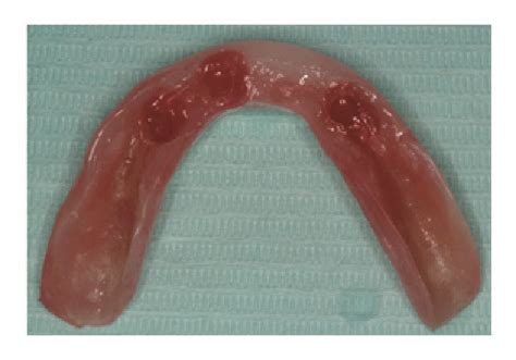 The Intaglio Surface Of The Mandibular Interim Denture Is Relined