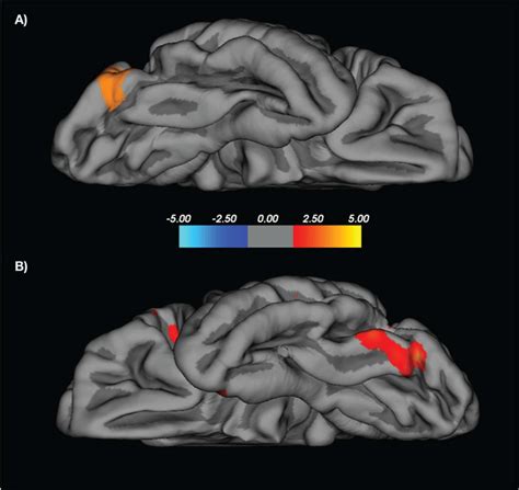 Surface Based Cortical Thickness Enlargements While Viewing Pictures Download Scientific