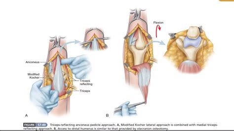 Distal Humeral Fracture Ppt