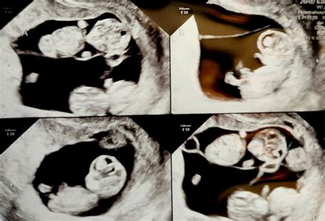 Texas Couple Welcomes Identical Quadruplet Girls Holy Moly