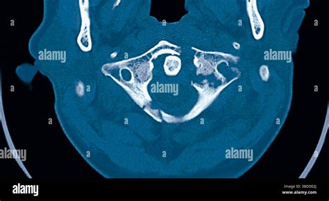 Coloured Computed Tomography Ct Scan Of A Jefferson Fracture A