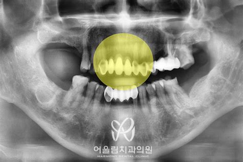 앞니 브릿지 임플란트 치료 어울림치과