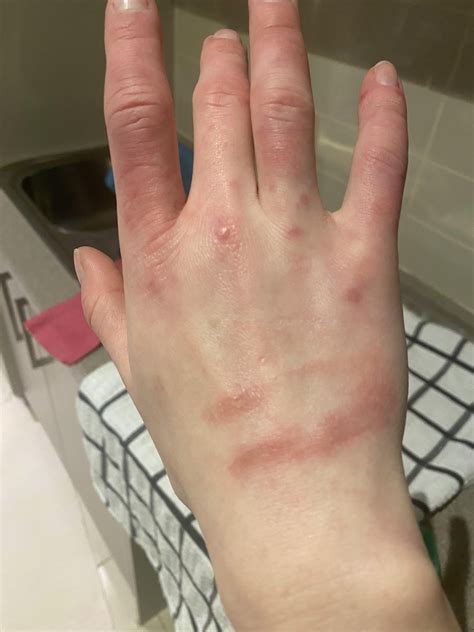 Heat Reaction R Scleroderma