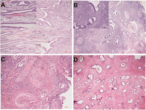 Effects Of Long Term Mifepristone On Eutopic Endometrium A The