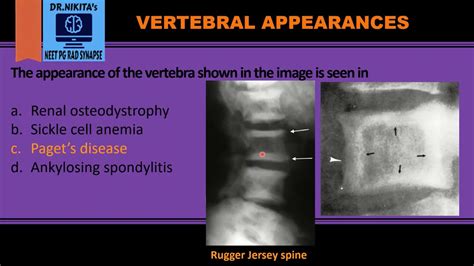 Pagets Disease Spine