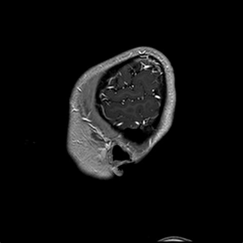 Filemitochondrial Encephalomyopathy Lactic Acidosis And Stroke Like