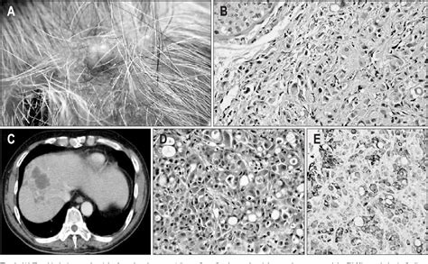 Figure 1 From Cutaneous Metastasis From Cholangiocarcinoma As The First