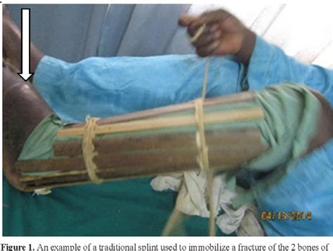 Figure 1 From A Rare Case Of Sequelae Of Iatrogenic Volkmann Syndrome