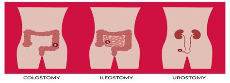 Understanding Having An Ostomy And Its Impact On Daily Life