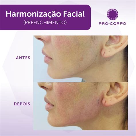 Harmonização Facial Harmoniza e rejuvenesce o seu rosto Pró Corpo