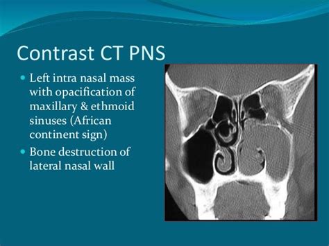 Neoplasms Of Nose And Pns