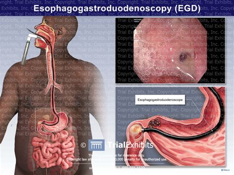 Esophagogastroduodenoscopy Egd Trial Exhibits Inc