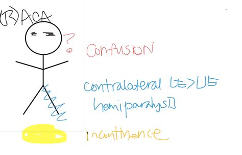 Stroke Mimics A Review Sinai Em