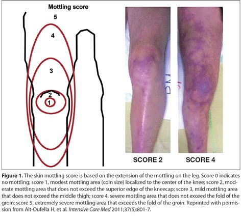 Sepsis Perfusion Assessment A Matter Of Seeing And Touching