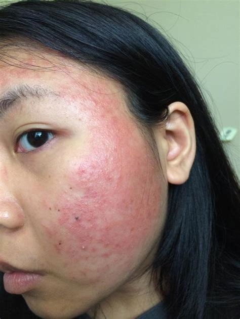 What Does An Allergic Reaction To Antibiotic Look Like At Emily Jenkins Blog