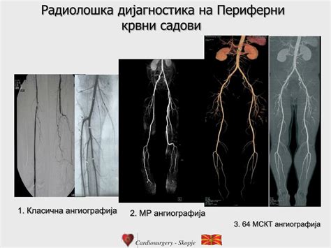 Ppt 64 слојна компјутеризирана томографија на периферни крвни садови