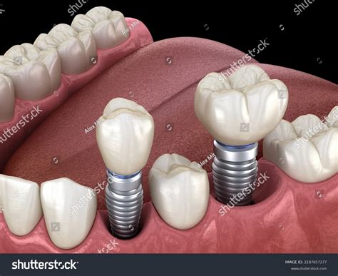 Premolar Molar Tooth Crown Installation Over Stock Illustration