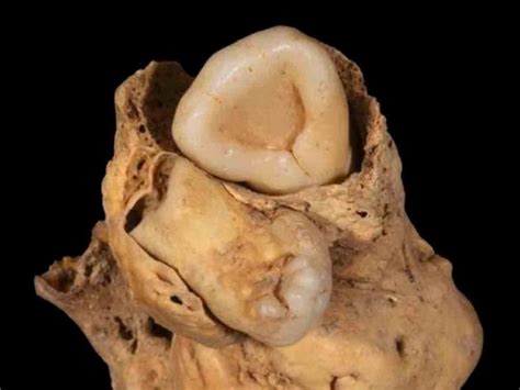 Científicos Hallan Un Tumor Con Dientes En El Antiguo Egipto Que