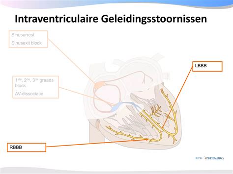 Ecgpedia Ecg Course Part Ii Ischemia Rhythm And Conduction Ppt