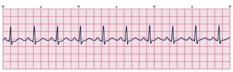 Rdsc 205 Patient Care Electrocardiogram Flashcards Quizlet