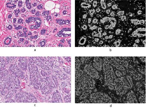 A Benign Proliferative Tissue Image And B Its Nuclei Detected Download Scientific Diagram