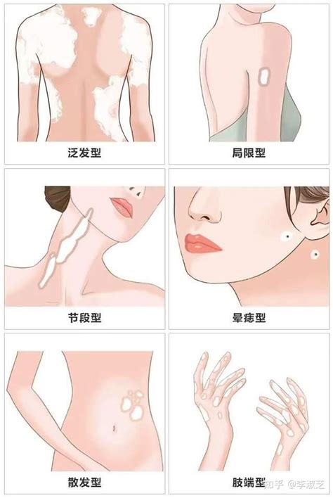 节段型白癜风的10大特征，一文读懂 知乎