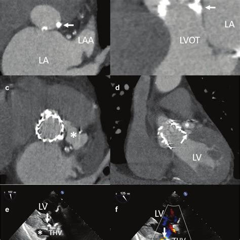 Association Between Aortic Valve Calcification And Paravalvular