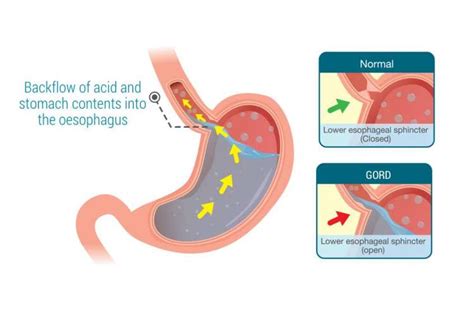 Gastroesophageal Reflux Disease Gord Mr Yahya Al Habbal