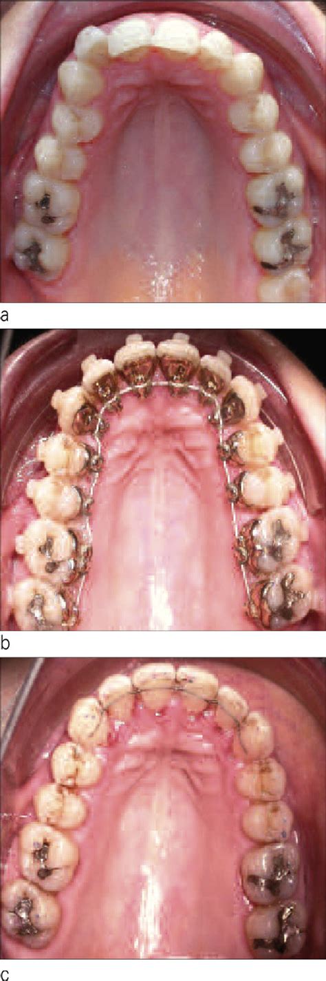A To 3c Clinical Case 1 Occlusal Views Of The Maxillary Arch A