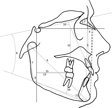 Skeletal And Dental Cephalometric Measurements 1 SNA Angle 2 SNB