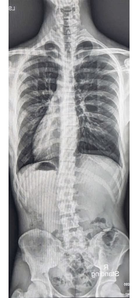 Cobb Angle And Measurements Rscoliosis