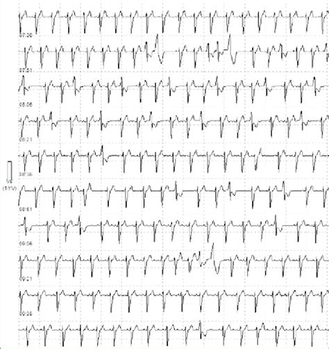 Ecg Fragment Of Patient A Continuous Recording In Lead V6 In The Download Scientific Diagram