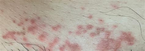 피부에 붉은 반점 얼룩이 올라왔어요 지식in