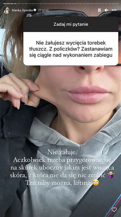 Lipińska o skutkach ubocznych operacji plastycznych Nie da się nic