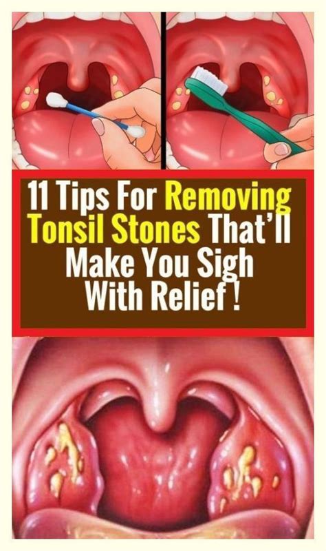 4 Ways To Remove Tonsil Stones Tonsilloliths Artofit